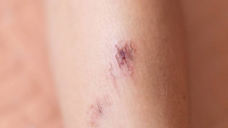 What to Do About a Scab on Your Lips – Entirely Health