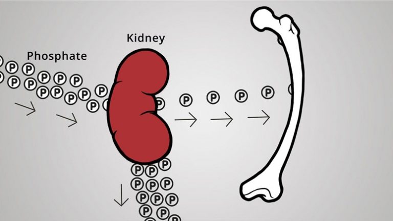 Hypophosphatemia: Symptoms, Causes, and Treatments – Page 5 – Entirely ...