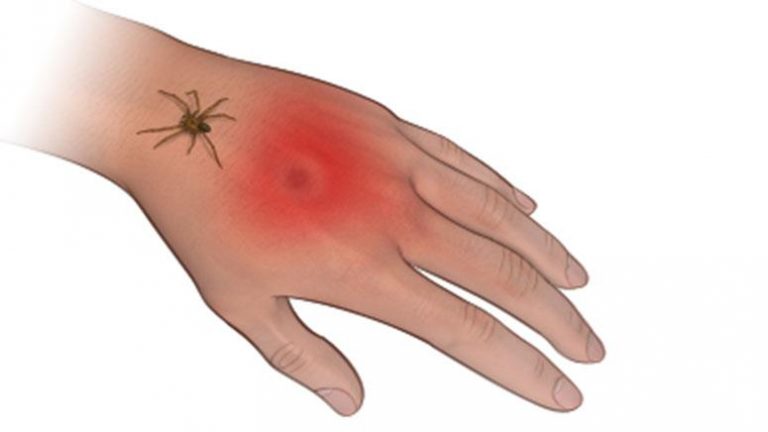 Identifying Spider Bites: Signs and Appearance – Page 7 – Entirely Health