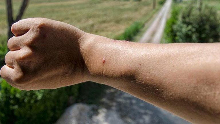 Identifying Spider Bites: Signs and Appearance – Entirely Health