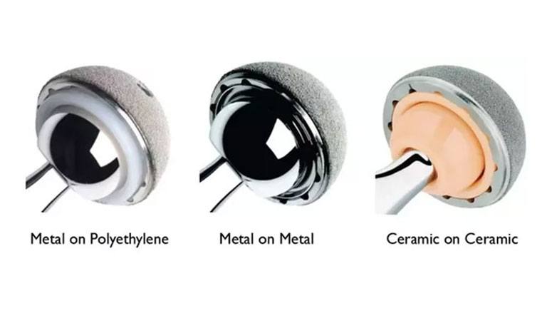 Ceramic Hip Replacement: Facts to Know – Page 3 – Entirely Health