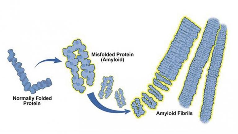 Amyloidosis: Causes, Types, Diagnosis and More – Entirely Health