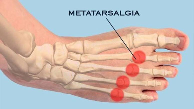 Metatarsalgia: Diagnosis, Treatment & More – Page 7 – Entirely Health