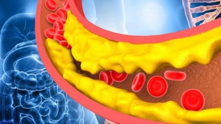 Hyperlipidemia: Symptoms, Causes, Diagnosis & Treatment – Entirely Health