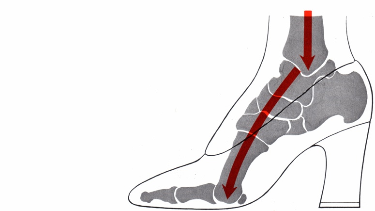 Metatarsalgia (Ball of Foot Pain): Symptoms and Causes – Page 3 ...