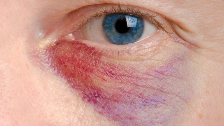 Amyloidosis: Causes, Types, Diagnosis and More – Page 2 – Entirely Health