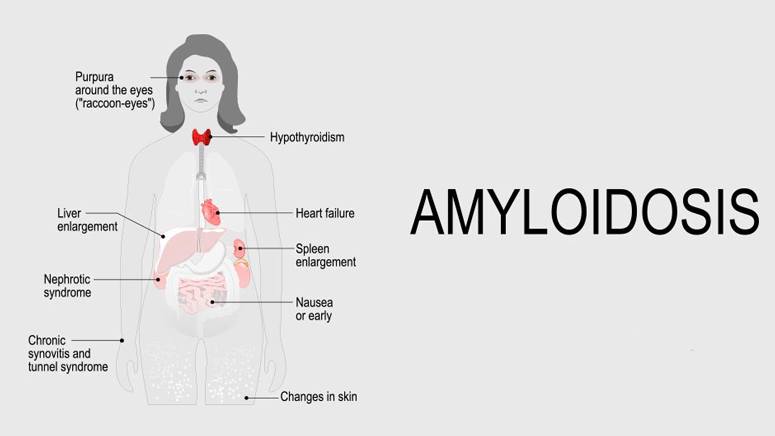 Amyloidosis: Causes, Types, Diagnosis and More – Entirely Health