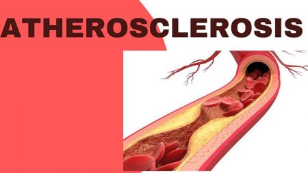 Atherosclerosis Meal Plans: What Should You Eat and Avoid – Entirely Health