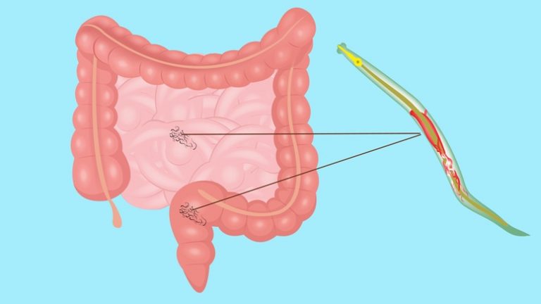 Pinworm Infection: Causes, Symptoms, Diagnosis & Treatments – Page 10 ...