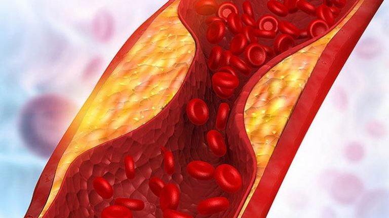 12 Surprising Causes of High Triglycerides – Entirely Health