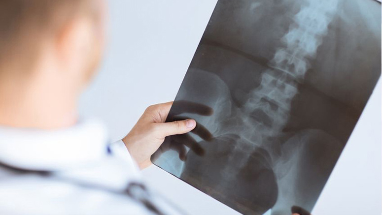 Cervical Spondylosis: Symptoms, Causes, and Treatments – Page 7 ...