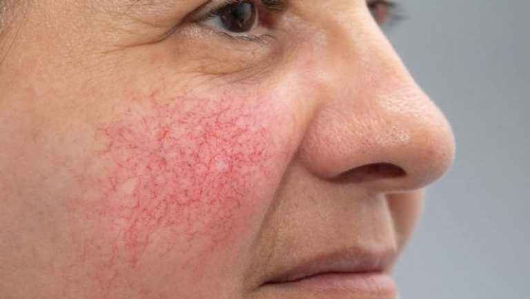 Rosacea: Signs and Symptoms – Page 2 – Entirely Health