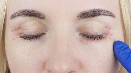 Rosacea: Signs and Symptoms – Page 5 – Entirely Health