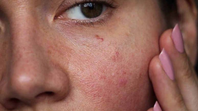 Rosacea: Causes & Risk Factors – Page 4 – Entirely Health