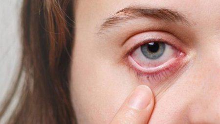 Keratitis: Symptoms, Causes, and Treatment – Page 2 – Entirely Health