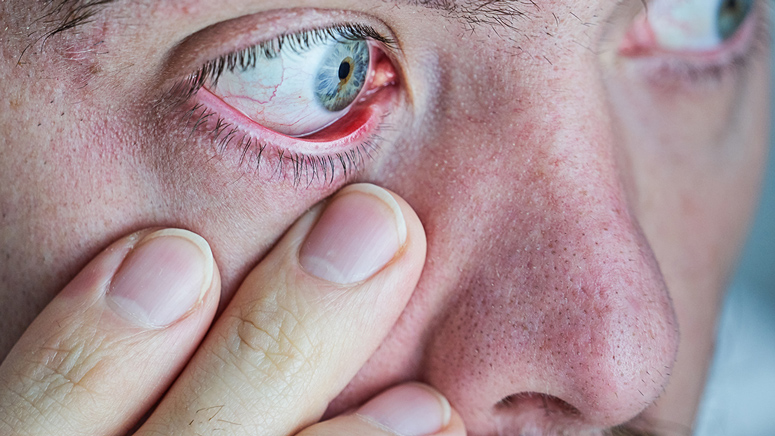 Red Eye: Causes, Treatment & Prevention – Page 3 – Entirely Health
