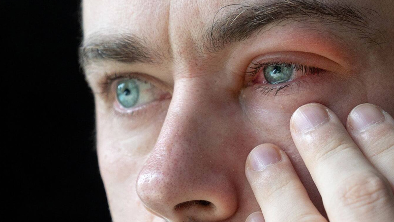 Red Eye: Causes, Treatment & Prevention – Page 5 – Entirely Health