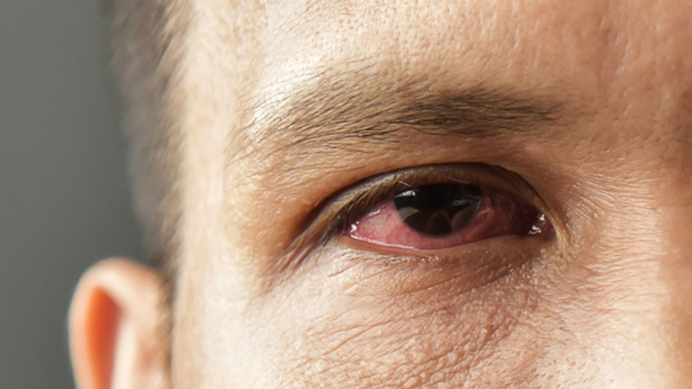 Red Eye: Causes, Treatment & Prevention – Entirely Health