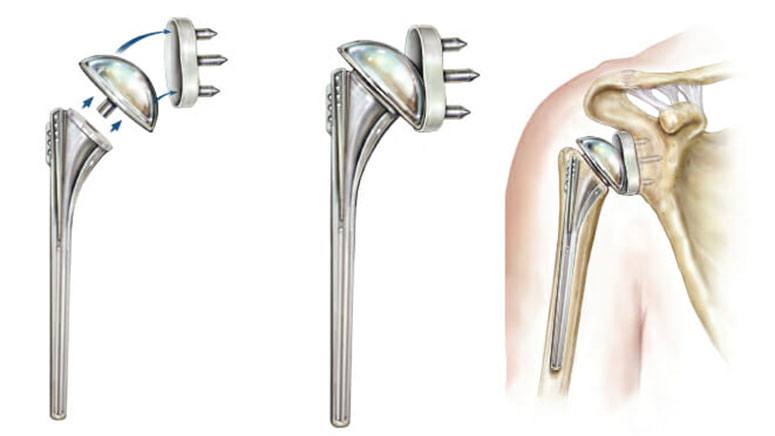 10 Effective Treatments for a Rotator Cuff Injury – Page 6 – Entirely ...