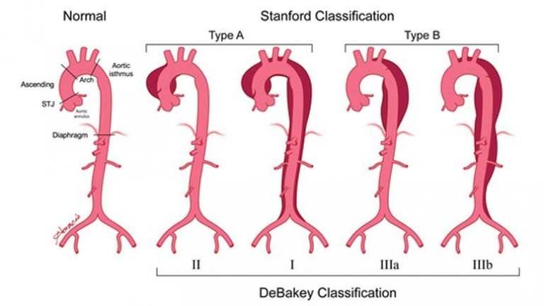 Aortic Dissection: Causes, Symptoms & Treatments – Page 2 – Entirely Health