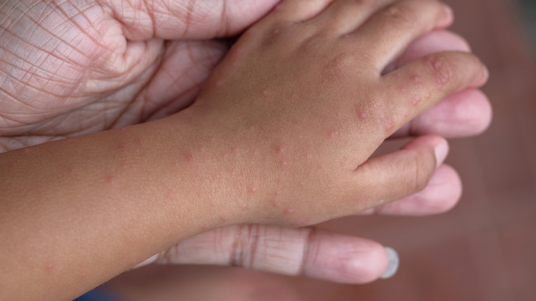 HFMD – Signs, Causes & Treatments – Page 8 – Entirely Health