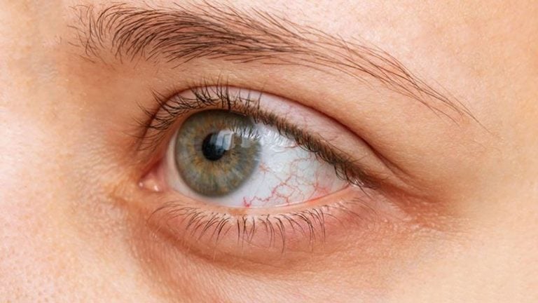 Burst Blood Vessel in the Eye: Causes and What to Do – Entirely Health