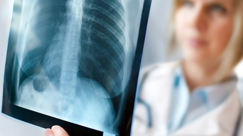 Valley Fever (Coccidioidomycosis): Causes, Symptoms & Treatment – Page ...