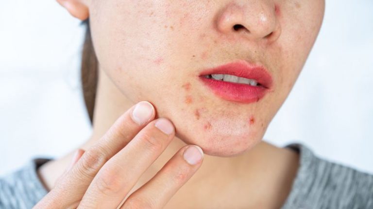 12 Tips To Get Rid of Bumps on Skin – Entirely Health