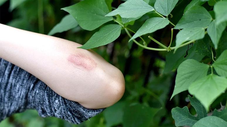 Poison Ivy, Oak & Sumac: Facts You Need to Know – Entirely Health