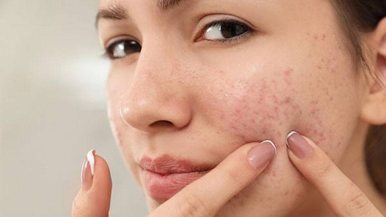 What Is Hidradenitis Suppurativa? – Page 4 – Entirely Health