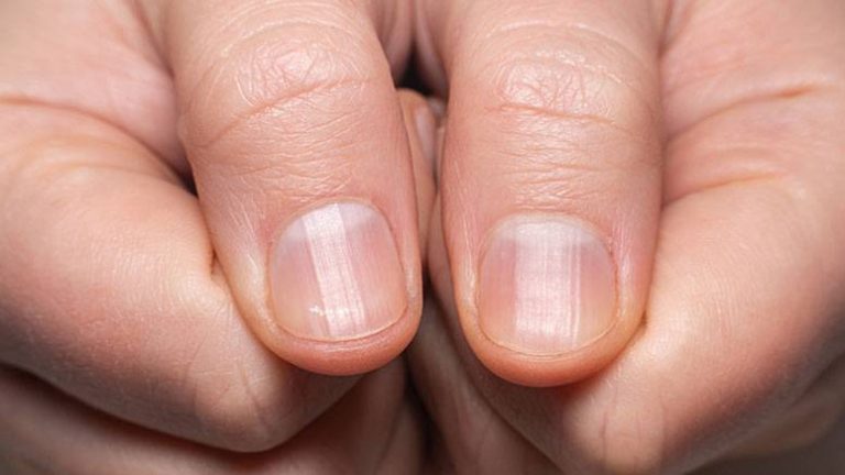Ridges in Fingernails: Types, Causes, and Treatment – Page 4 – Entirely ...