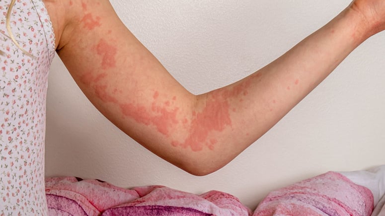 Spotting the Signs: 10 Symptoms of Rubella – Page 4 – Entirely Health