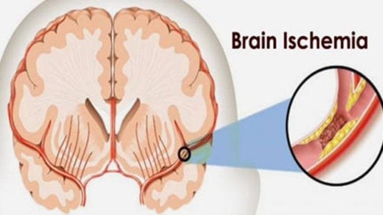 Ischemia Symptoms, Causes, Treatments, and Prognosis – Page 5 ...