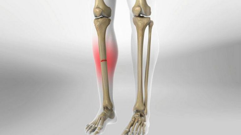 10 Tibial Fractures Causes – Entirely Health