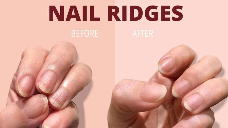 Ridges in Fingernails: Types, Causes, and Treatment – Page 6 – Entirely ...