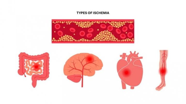 Ischemia Symptoms, Causes, Treatments, and Prognosis – Page 4 ...