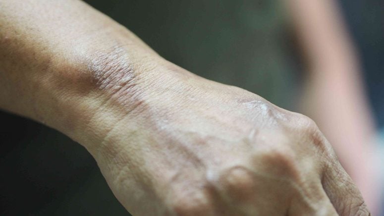 Leprosy (Hansen’s Disease): Causes, Symptoms, and Treatment – Page 3 ...